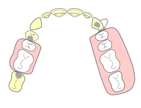 Partial Dentures | Dental Elementary